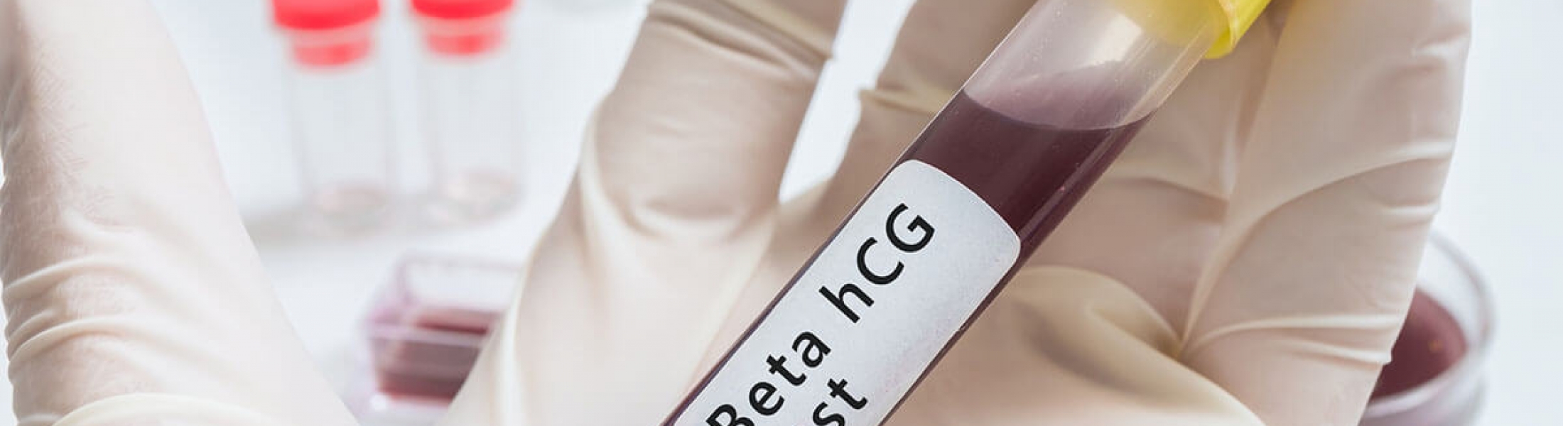 Beta hCG : qu'est-ce que c'est et comment les résultats sont ...